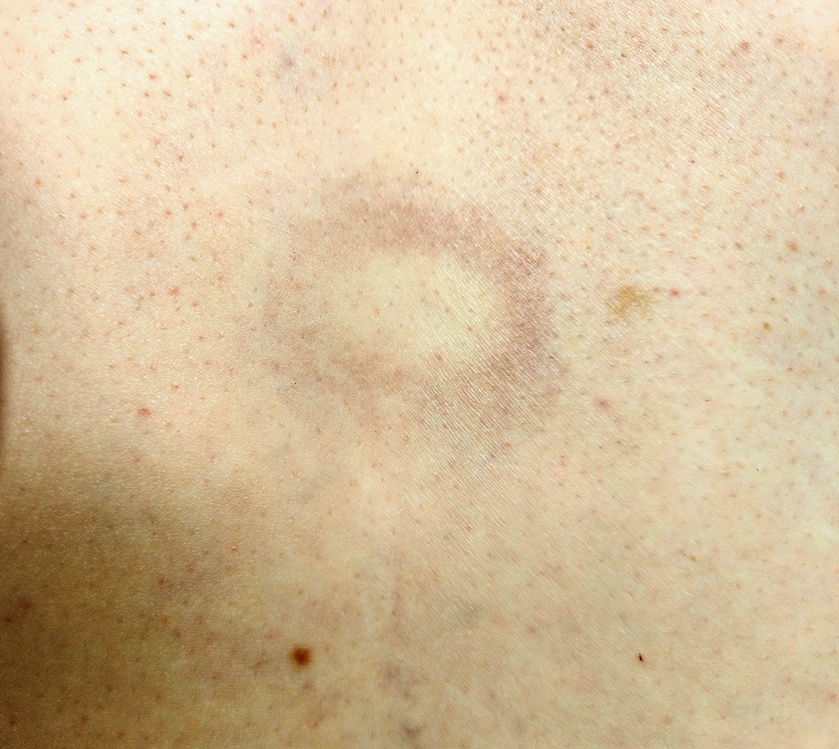 Shared post - Blew's bruise 1 week later