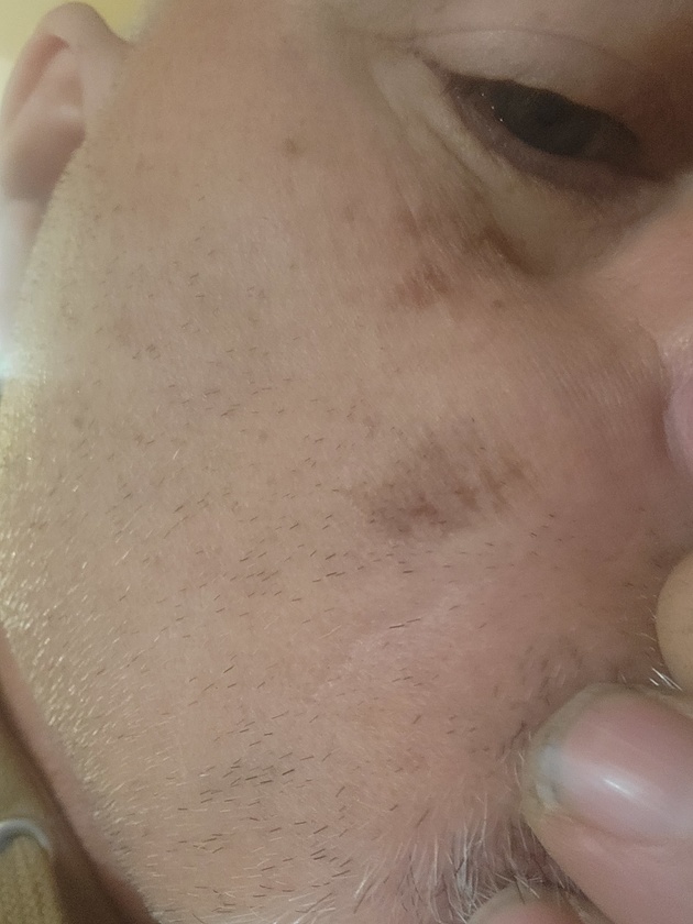 Shared post - Frostbite recovery day 3